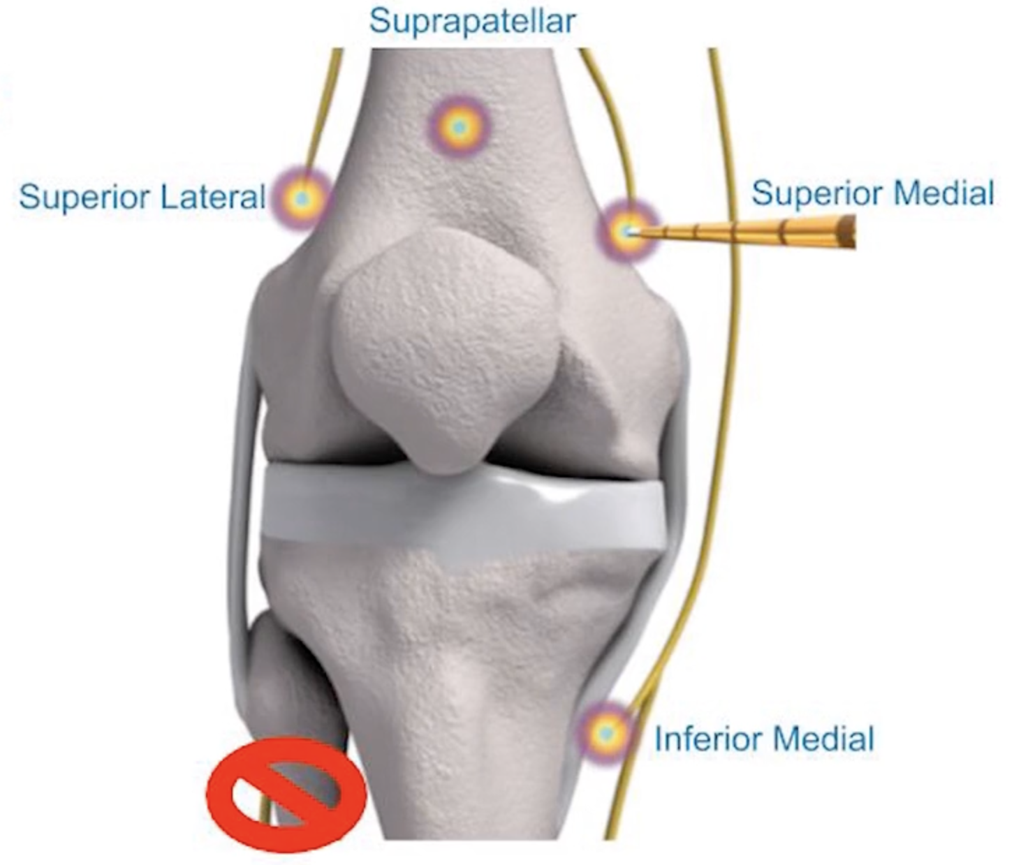 Radiofrecuencia para el Tratamiento del Dolor Crónico